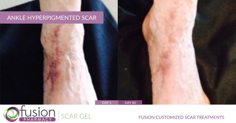 Hyperpigmented Scar Treatment | Fusion Specialty Pharmacy