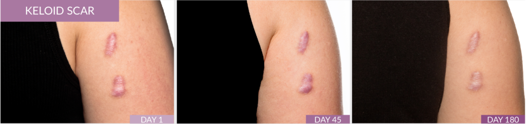 Fusion Keloid Scar Treatment | Fusion Specialty Pharmacy