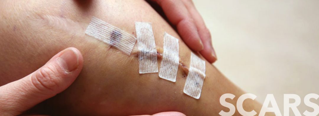 Scar Gel / Scar Treatment | Fusion Specialty Pharmacy